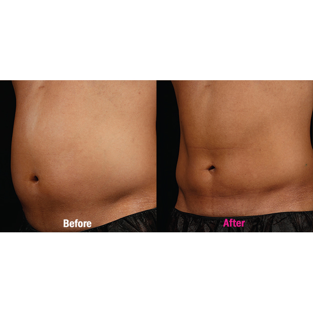 Warm + CoolSculpting™